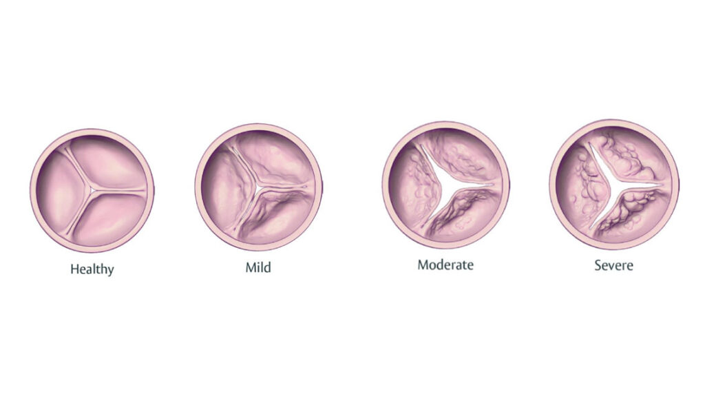 Aortic Stenosis & Treatment Options - Medicus Network - Find your ...